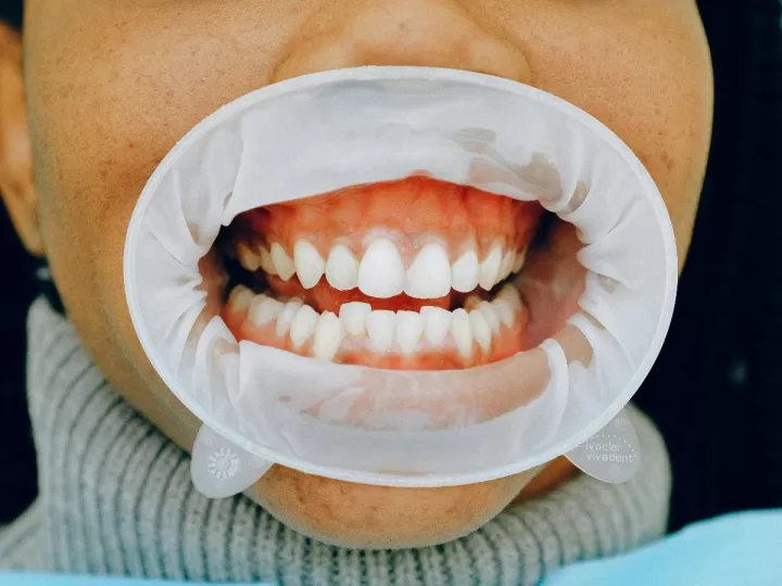 Descubre la mejor opción de pegamento para tus dientes: durabilidad ...